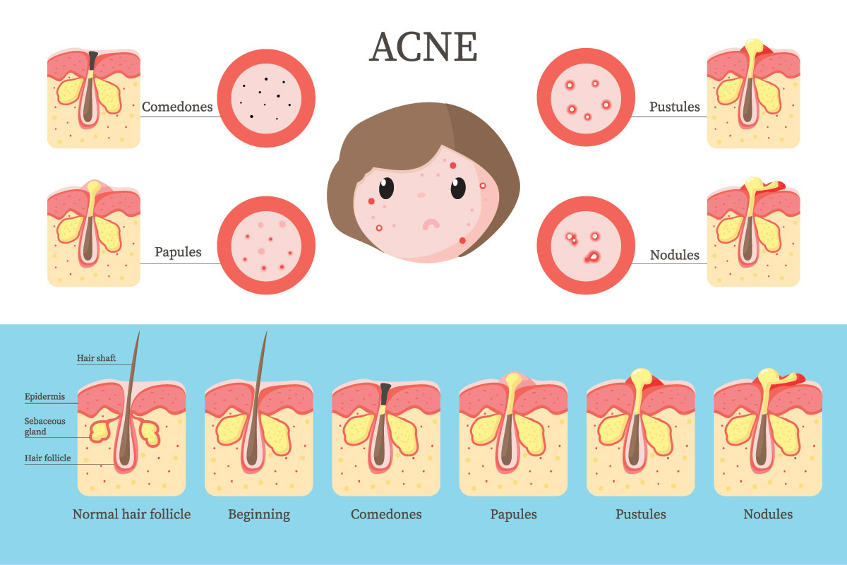 Reduce Pimples with LACTEZIN® | Lactezin
